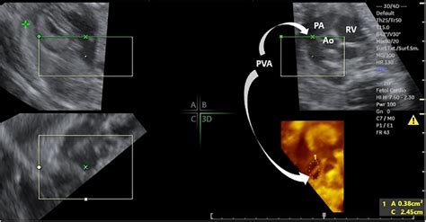Imaging Of The Fetal Heart Stic In The Three Orthogonal Planes With