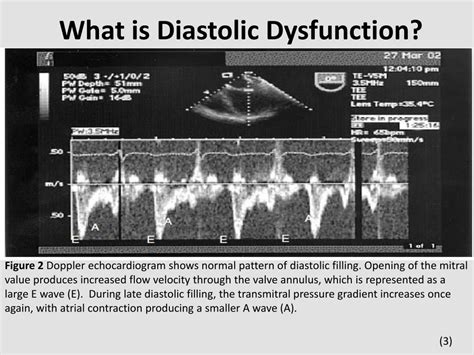 Ppt Diastolic Dysfunction As Diagnosed And Quantified By