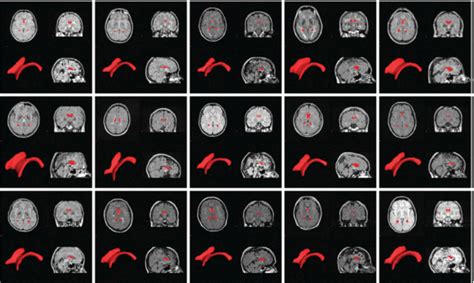 Example Of Fully Automatic Segmentations Performed By The Neurological Download Scientific