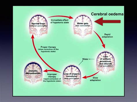 Assessment And Treatment Of Acute Hyponatraemia Ppt