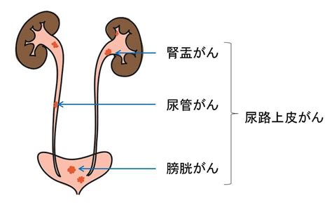 腎盂尿管がんを患った有名人の今は？前兆、後遺症、生存率についてまとめました ｜ 癌は早期発見が大事なんだね