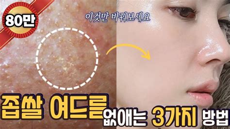 02 지긋지긋한 좁쌀 여드름 없애는 꿀팁 3가지 화장품 업계 16년차가 알려주는 근본 원인과 꿀팁 공개 3 Ways