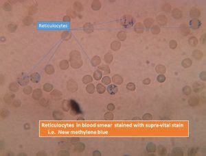 Reticulocyte Count Introduction Determination Normal Range And Clinic