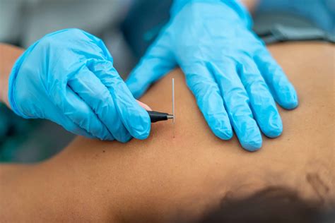What Is Dry Needling Trigger Point Dry Needling In Austin Tx Frwd