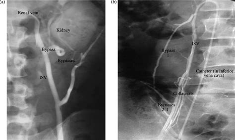 A Left Side Venography Of A Patient With Bilateral Varicocele