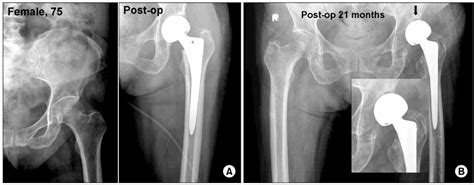 Femoral Neck Fractures Hemiarthroplasty And Total Hip