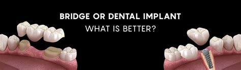 Dental Implant Or Bridge What Is Better Dentusdentino