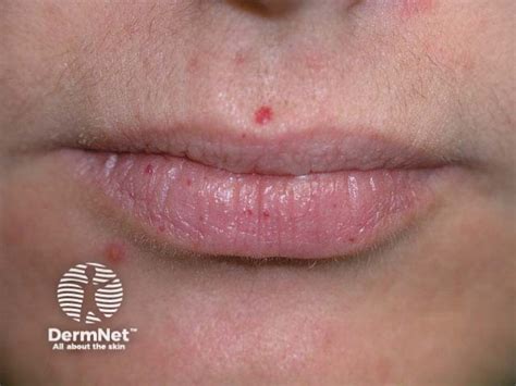 Telangiectasia 10 Cases