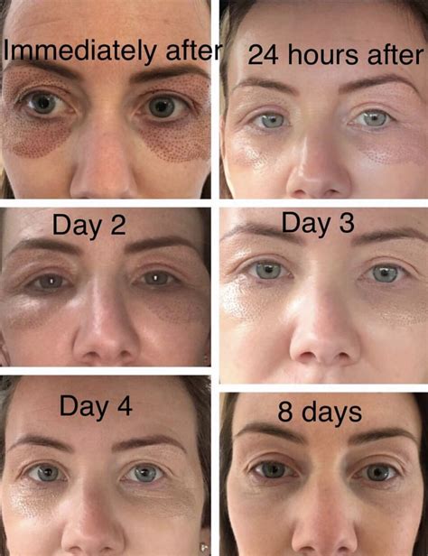Laser Under Eye Wrinkles Before After Augsburgermakowsky