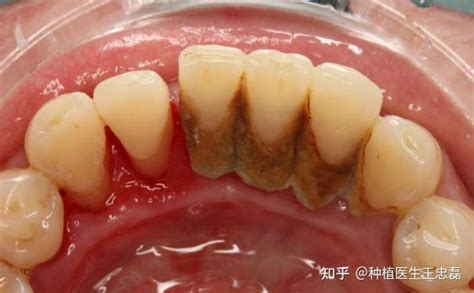 慢性牙周炎不治疗会怎么样？后果比你想象中痛苦百倍！ 知乎