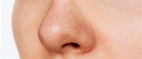 Kulit Halus Tanpa Komedo Ini Trik Kecilkan Dan Bersihkan Pori Pori