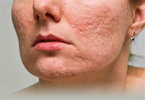 Atrophic Scars Types Causes And Treatments Awd Med