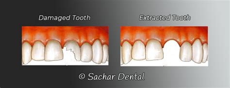 Dentist Nyc Tooth Extraction Nyc Sachar Dental Nyc