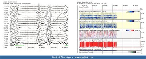 Eeg Monitoring In The Intensive Care Unit Medlink Neurology