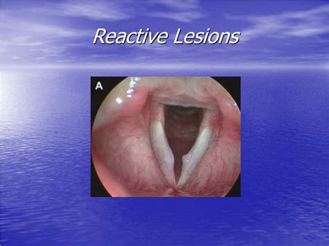 Ppt Benign Laryngeal Lesions Powerpoint Presentation Free Download