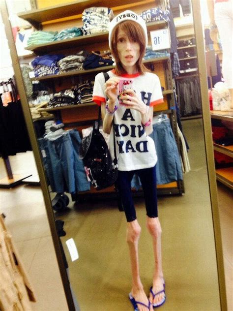 Rachel Farrokh Absolutely The Worst Case Of Anorexia Ive Ever Seen