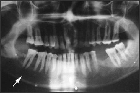 A Nodular Swelling At The Lingual Aspect Of The Right Permanent