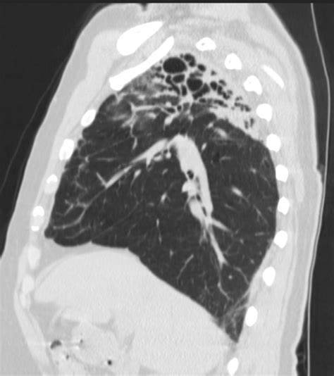 073lu Tb Bronchiectasis The Common Vein