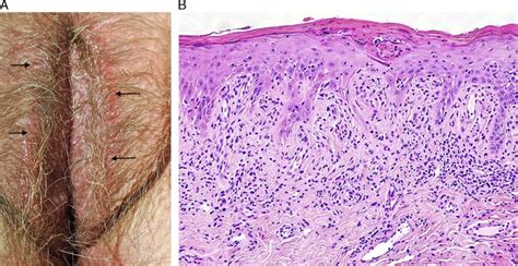 Classic And Hypertrophic Vulvar Lichen Planus Pmc