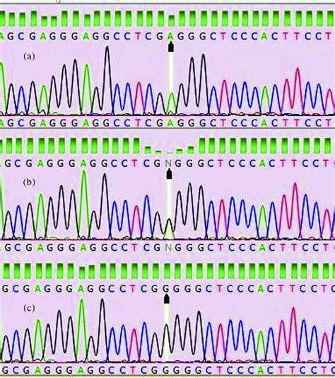 A Partial Electrophoregram Of Ar Gene Exon 1 Of The Proband Sa125 Download Scientific