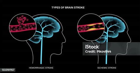 Ictus Cerebrale Isemico Ed Emorragico Immagini Vettoriali Stock E