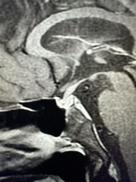 Understanding Hypophysitis Symptoms Diagnosis And Treatment Pituitary World News