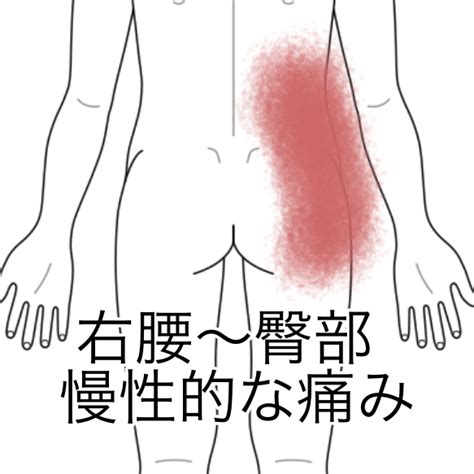 約20年痛み続けた右腰臀部臀部痛腰痛のツボツボネット 鍼灸の症例が検索できるツボ辞典