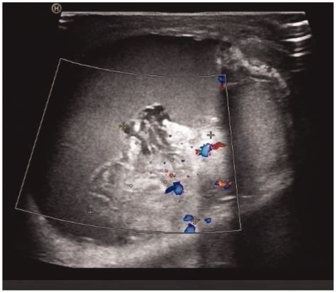 Ultrasound Of The Scrotum Revealed High Echogenicity In The Right