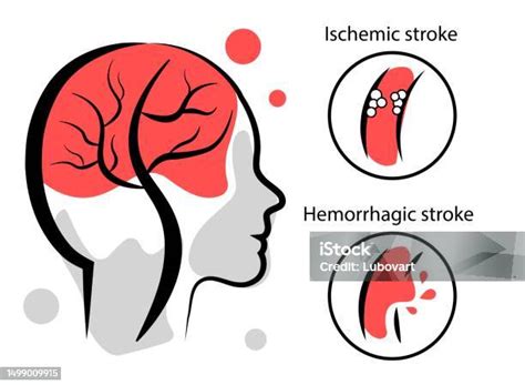 Ictus Ischemico Ictus Emorragico Immagini Vettoriali Stock E Altre