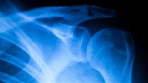 SIRVA Shoulder Injury Rotator Cuff Tears From Flu Shot Or Vaccine
