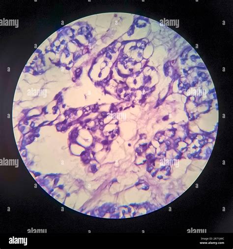 Thyroid Follicular Carcinoma Light Micrograph Photo Under Microscope