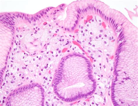 Pathology Outlines Xanthoma