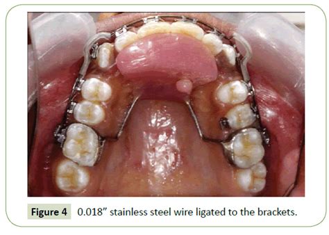 Modified Nance Palatal Arch Insight Medical Publishing