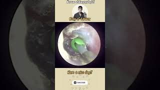 귀지형 귀지 귀지제거 귀파기 귀파기asmr 귀청소 이비인후과 earwax earwaxremoval asmr