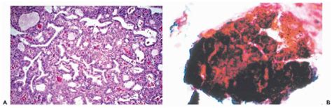 Benign Disorders Of The Uterine Cervix And Vagina Basicmedical Key