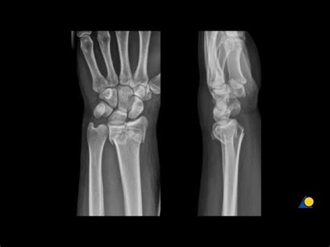 Radius Distal Reverse Bartons Fracture 23b3 Fixation Using Two