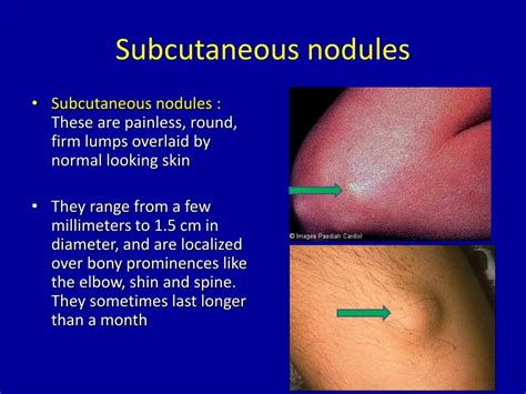 Subcutaneous Nodules Rheumatic Fever