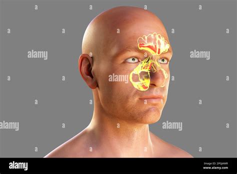 Infection Sinusale Ou Sinusite Illustration Informatique Les Sinus