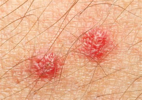 Human Bite Mark Tattoos