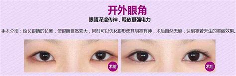 开眼角图片开眼角症状表现图片大全有来医生