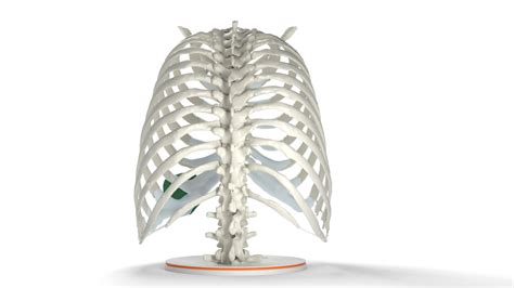 Chest Wall Tumor Chondrosarcoma Custom 3d Anatomy Models Gpi 3d Anatomy