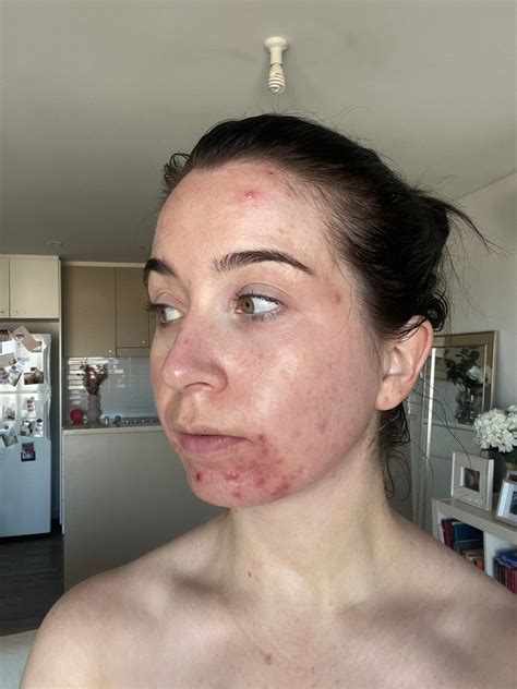 The Emotional Toll Of Having Acne In Your Late 20s