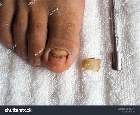 Toe Without Nail