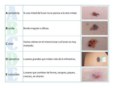 Lunares Peligrosos Centro Dermatológico Leal