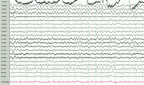 Eeg And Semiology In Generalized Epilepsies Neupsy Key