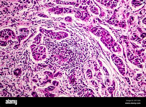 Lymph Node Metastasis Light Micrograph Of Cancer That Has Spread To A
