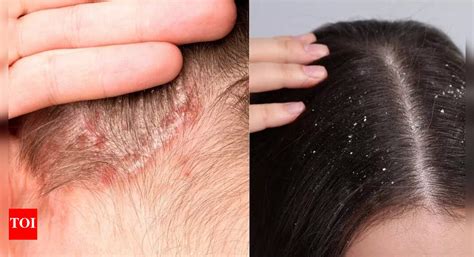 Eating Scalp Psoriasis Flakes