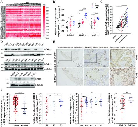 Hox Genes Expression Patterns And Clinical Significance Of Hoxd11 In