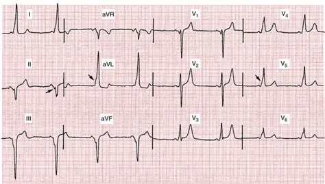 Wolff Parkinson White Preexcitation Patterns Thoracic Key