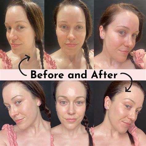 Dhs13k Sofwave Laser Experience And Results